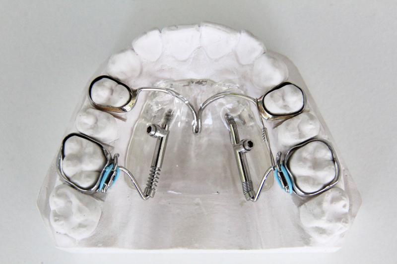 Moderne Methoden | Zahnspange Gießen